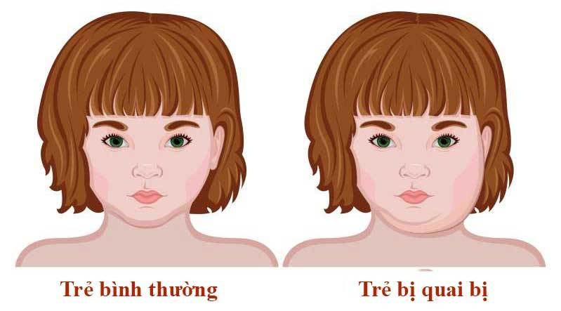 7 dấu hiệu của bệnh quai bị | Báo Dân trí