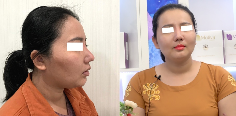Số phận của những ca phẫu thuật thẩm mỹ mũi hỏng sẽ đi về đâu? | Báo ...